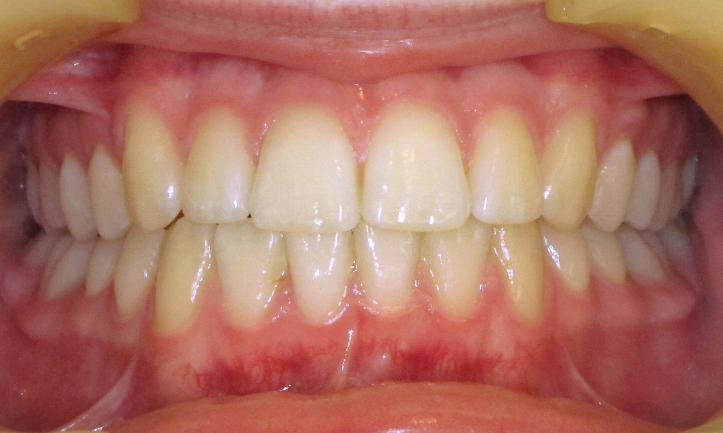 Quick Straight Teeth | Whitegates Dental Clinic